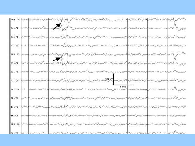 Eeg in pediatric (DNB PEDIATRIC) | PPTX | Brain and Nervous System ...