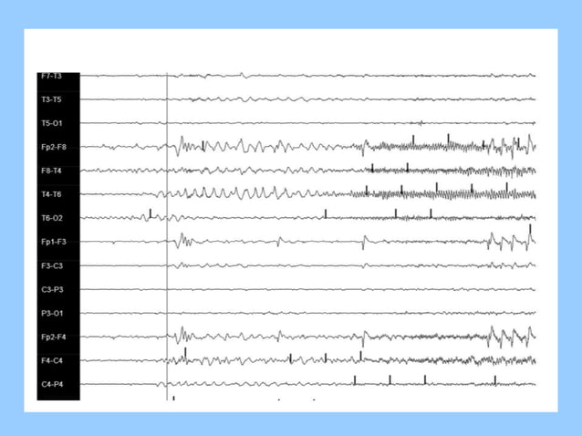 Eeg in pediatric (DNB PEDIATRIC) | PPTX | Brain and Nervous System ...