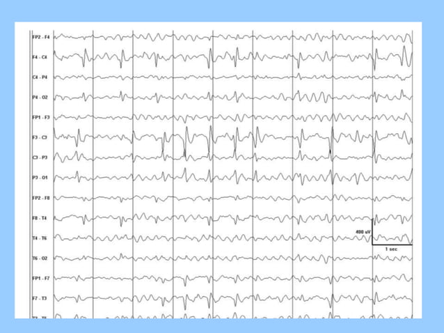 Eeg in pediatric (DNB PEDIATRIC) | PPTX | Brain and Nervous System ...