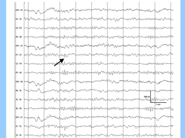 Eeg in pediatric (DNB PEDIATRIC) | PPTX | Brain and Nervous System ...