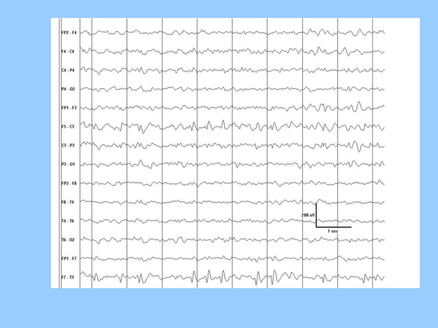 Eeg in pediatric (DNB PEDIATRIC) | PPTX | Brain and Nervous System ...