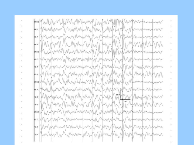 Eeg in pediatric (DNB PEDIATRIC) | PPTX | Brain and Nervous System ...