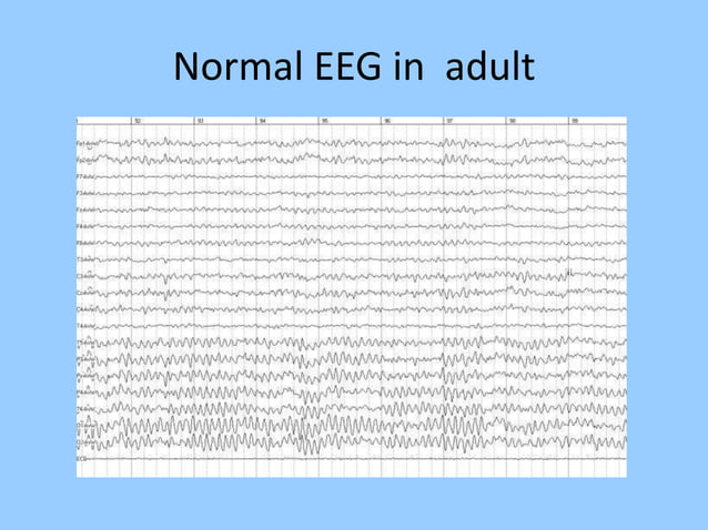 Eeg in pediatric (DNB PEDIATRIC) | PPTX | Brain and Nervous System ...