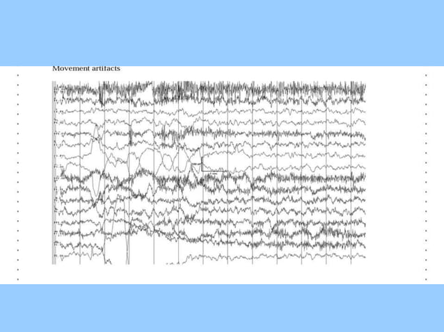 Eeg in pediatric (DNB PEDIATRIC)
