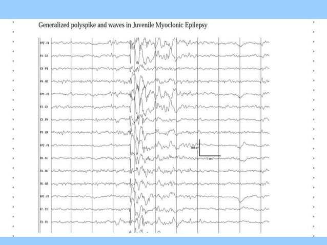 Eeg In Pediatric Dnb Pediatric
