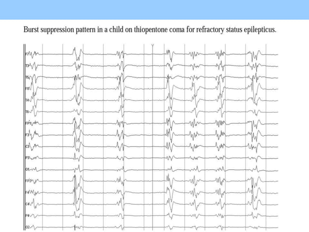 Eeg In Pediatric Dnb Pediatric