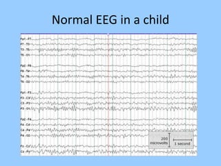 Normal Pediatric Eeg