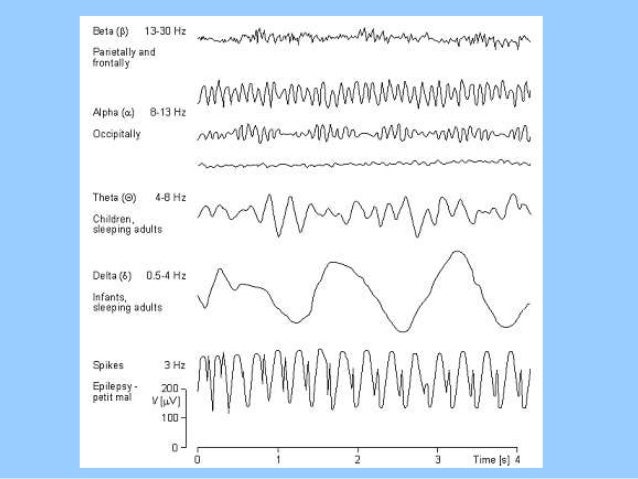 Eeg in pediatric (DNB PEDIATRIC)
