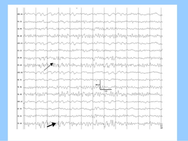 Eeg In Pediatric Dnb Pediatric