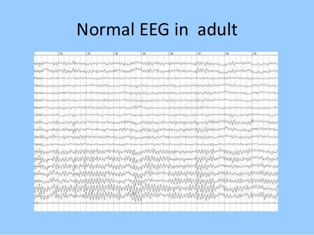 Eeg in pediatric (DNB PEDIATRIC)