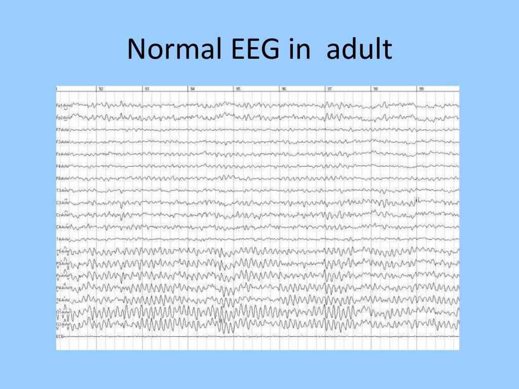 Eeg In Pediatric Dnb Pediatric