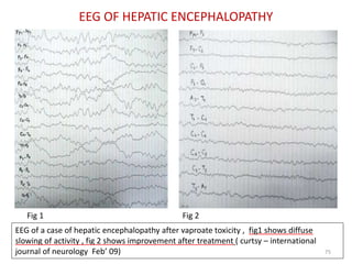 EEG in neurology and psychiatry | PPTX