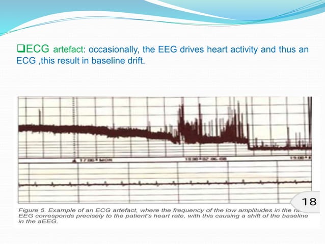 Amplitude - INTEGRATED( aEEG) | PPTX | Pregnancy | Reproductive Health