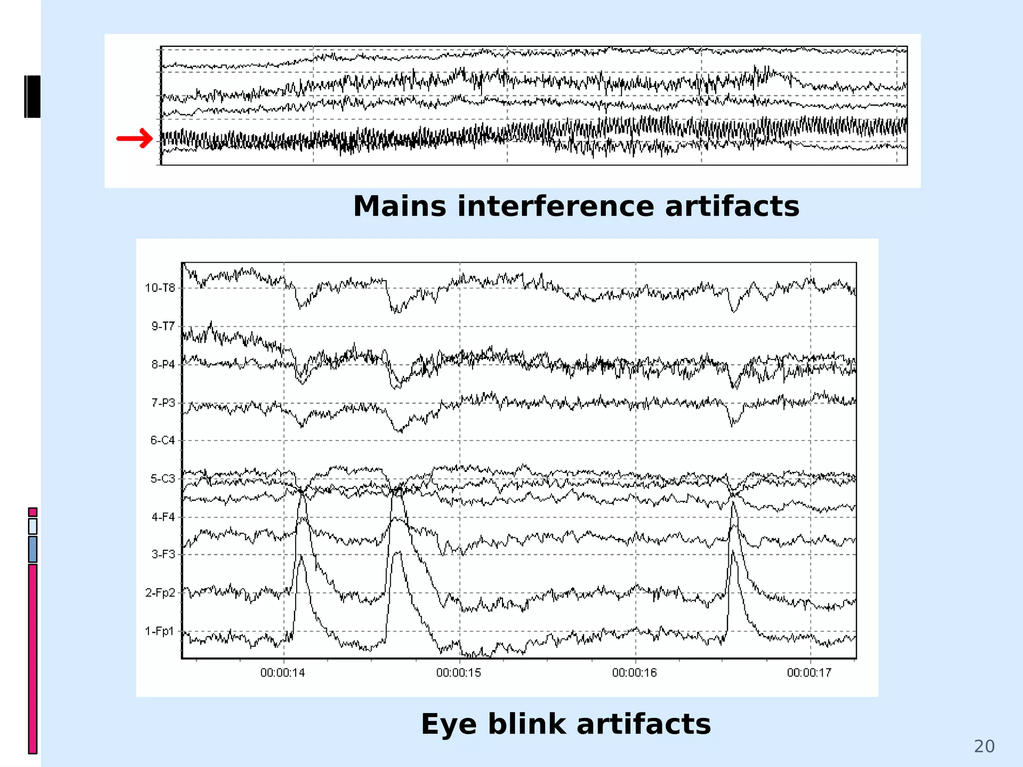 Eeg | PDF