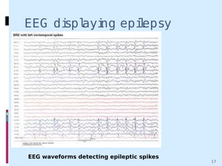 Eeg | PDF