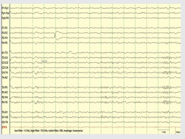 Eeg | PPT | Sleep Disorders | Diseases and Conditions