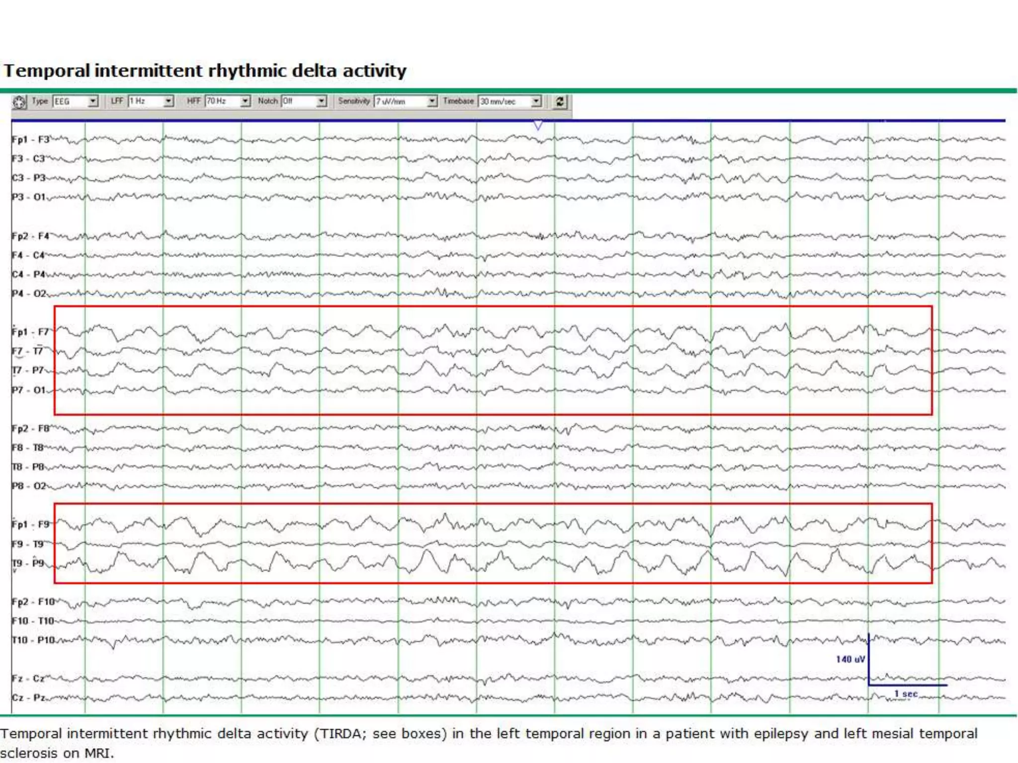 Eeg basics, part 1 | PPT