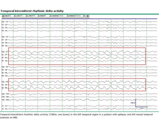 Eeg basics, part 1 | PPT
