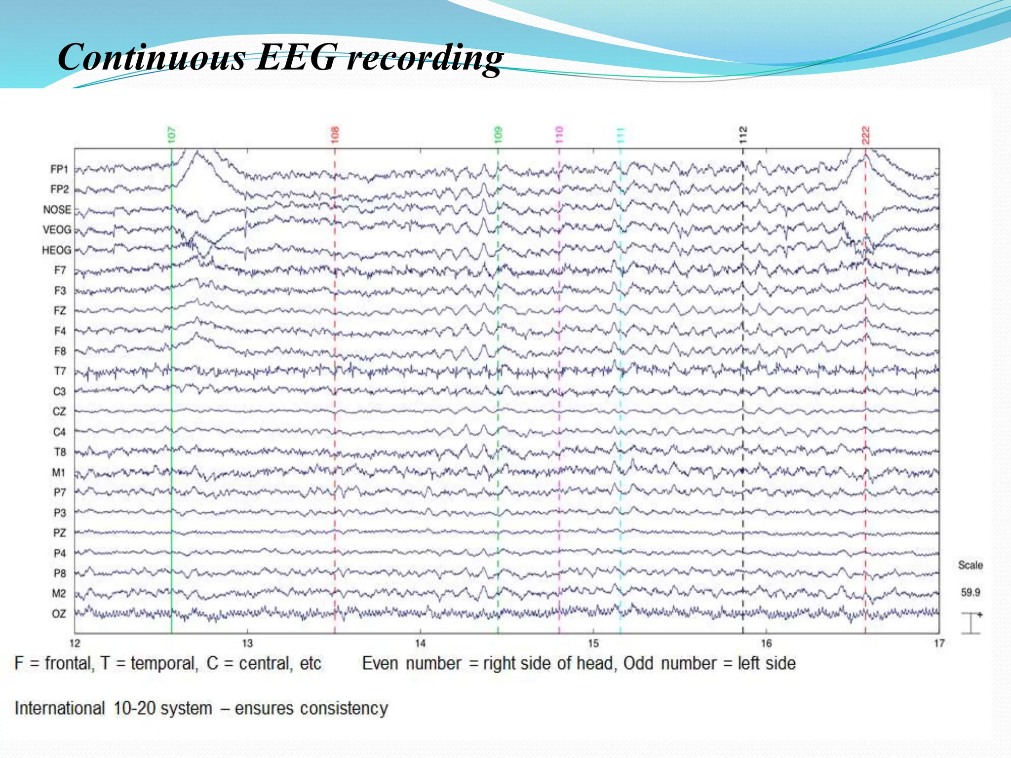 Electro encephalo graphy (EEG) Lecture.pptx