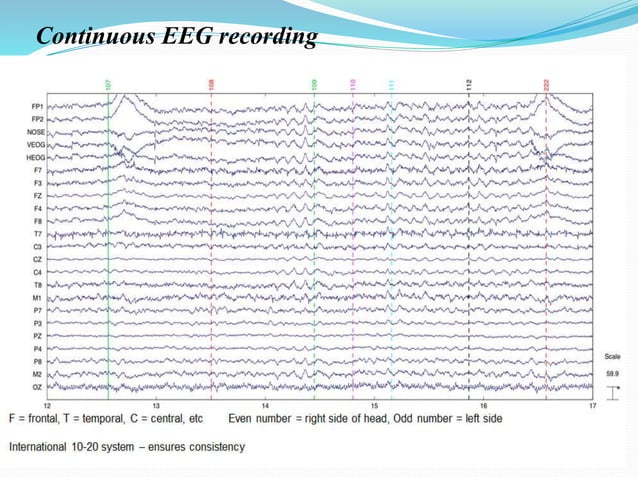 Electro encephalo graphy (EEG) Lecture.pptx