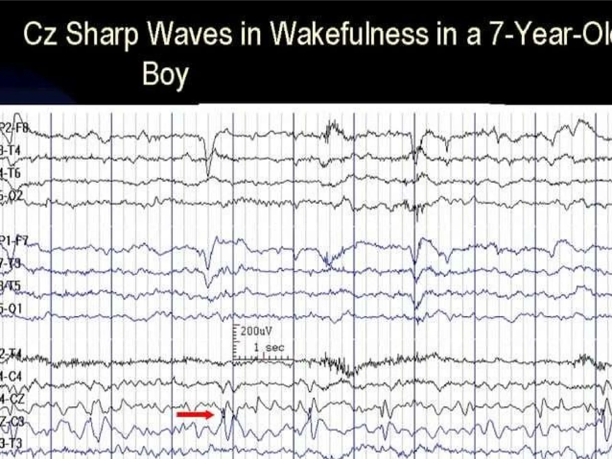 BASICS OF ELECTRO ENCEPHALOGRAM EEG - BASICS | PPTX