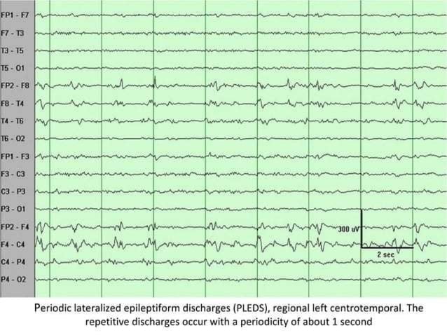 BASICS OF ELECTRO ENCEPHALOGRAM EEG - BASICS | PPTX | Brain and Nervous ...