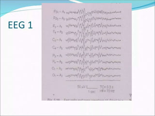 BASICS OF ELECTRO ENCEPHALOGRAM EEG - BASICS | PPTX