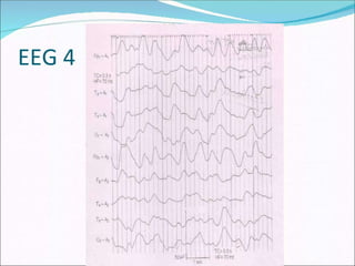 BASICS OF ELECTRO ENCEPHALOGRAM EEG - BASICS | PPTX