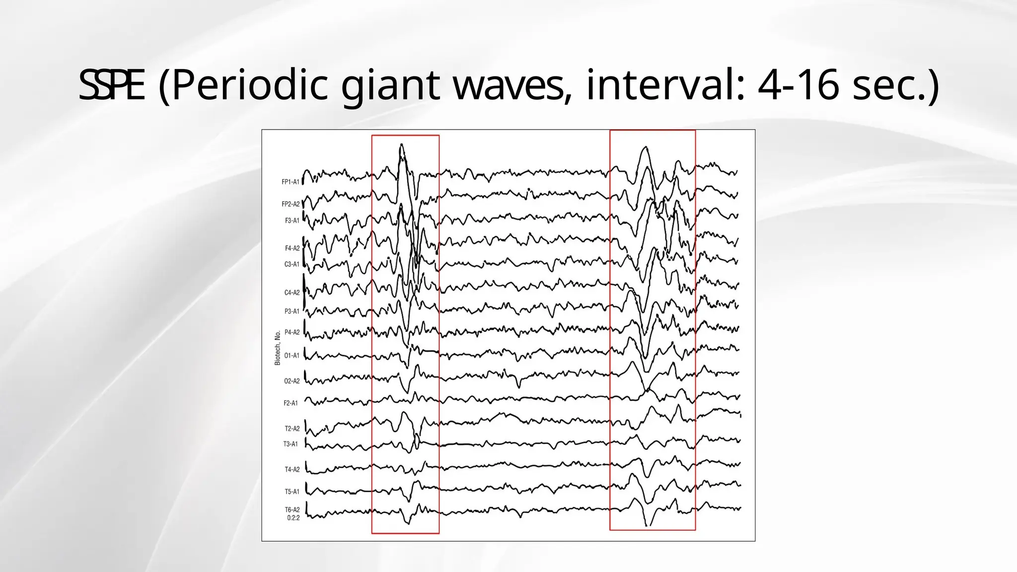 EEG different waves, procedure and eeg patterns in diseases | PPTX