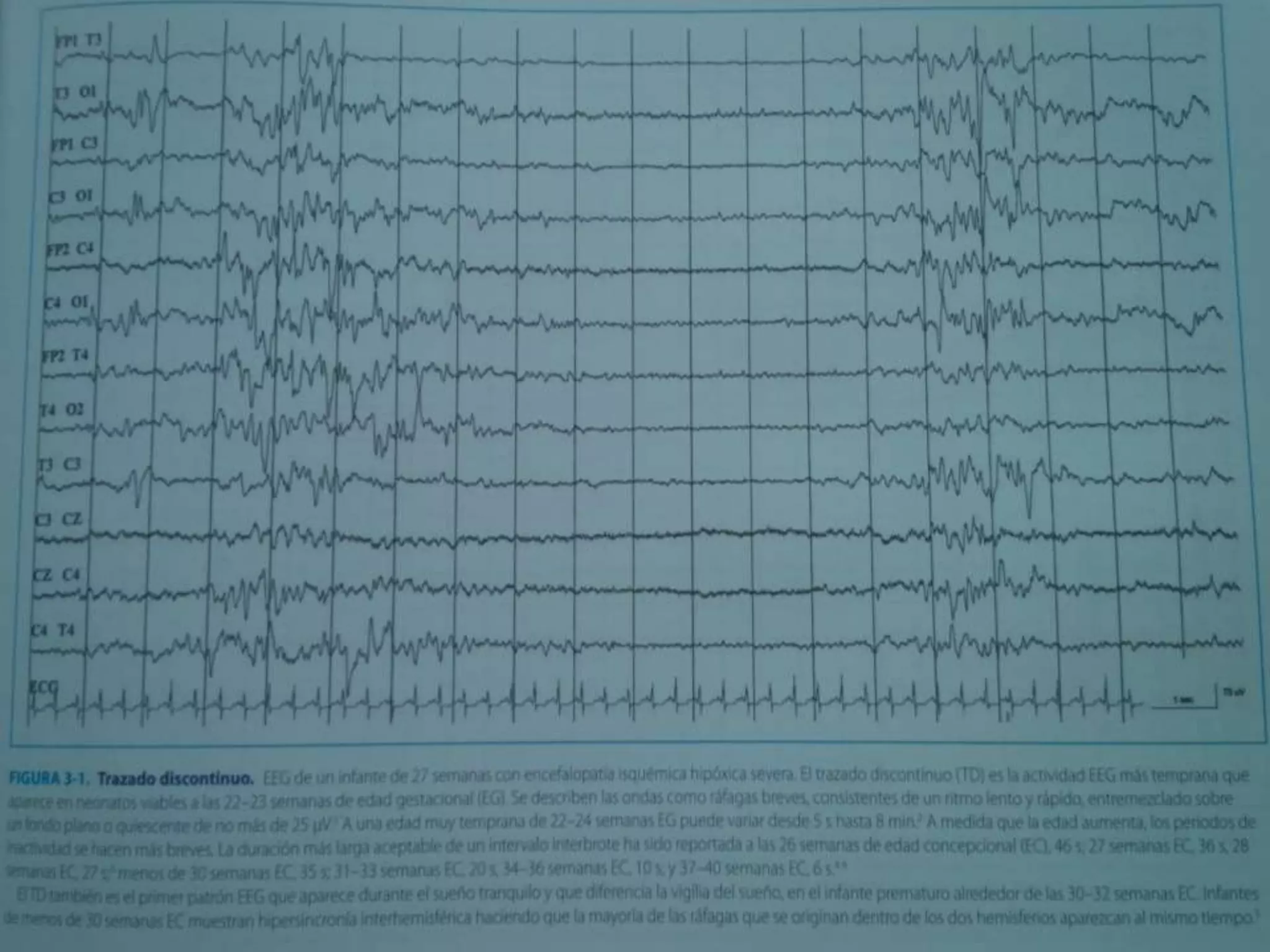 Eeg neonatal | PPTX