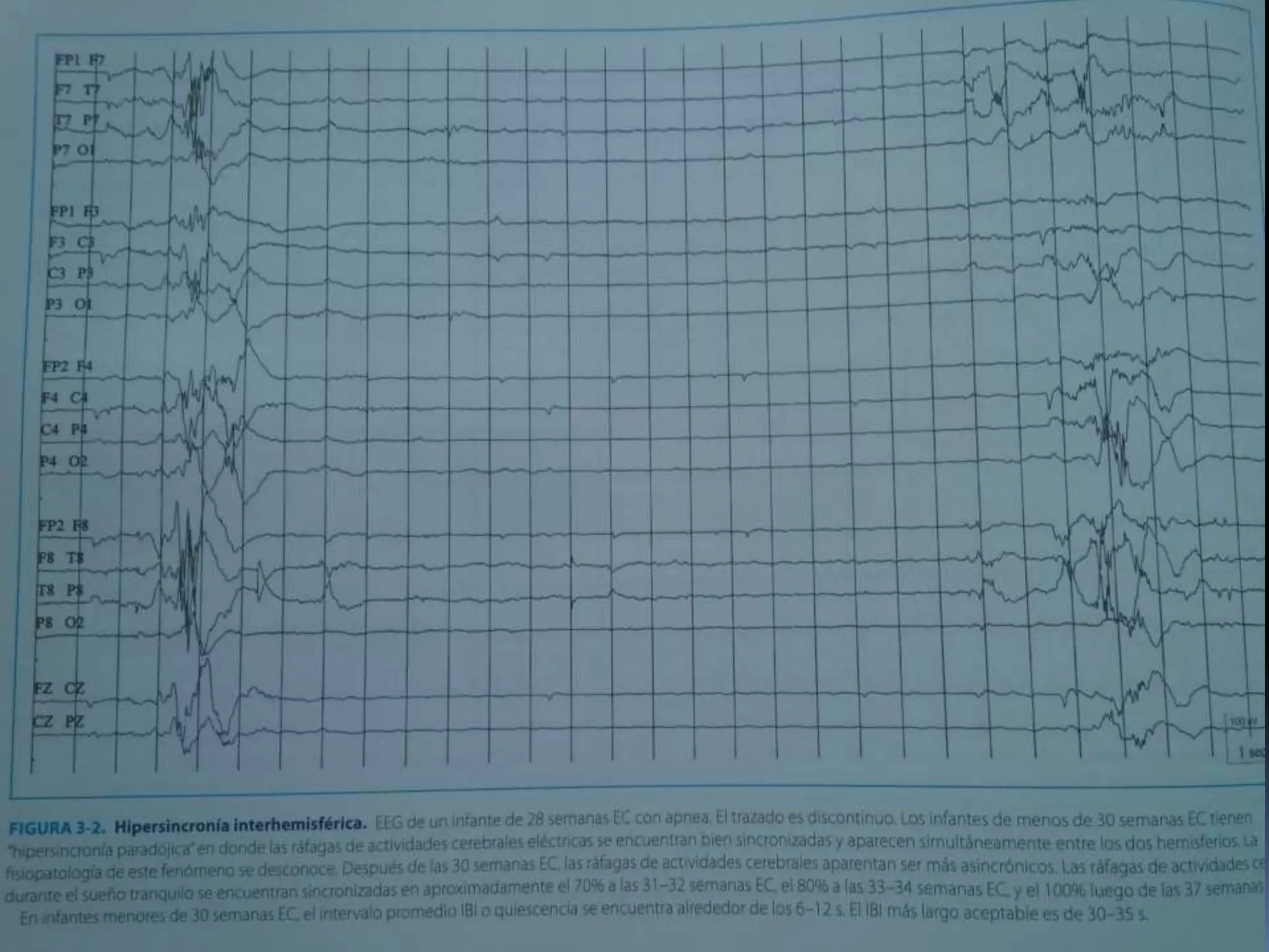 Eeg neonatal | PPTX