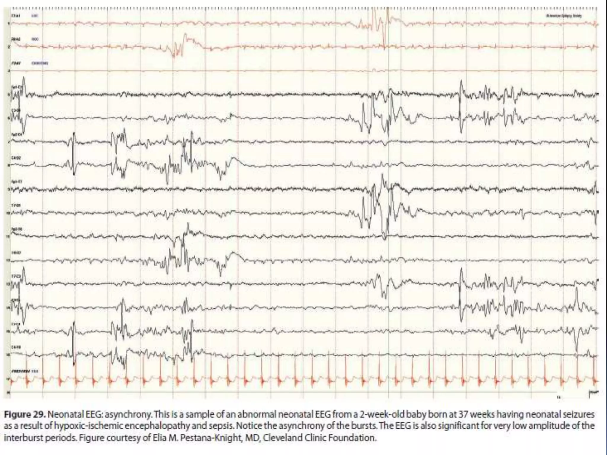 Eeg neonatal | PPTX