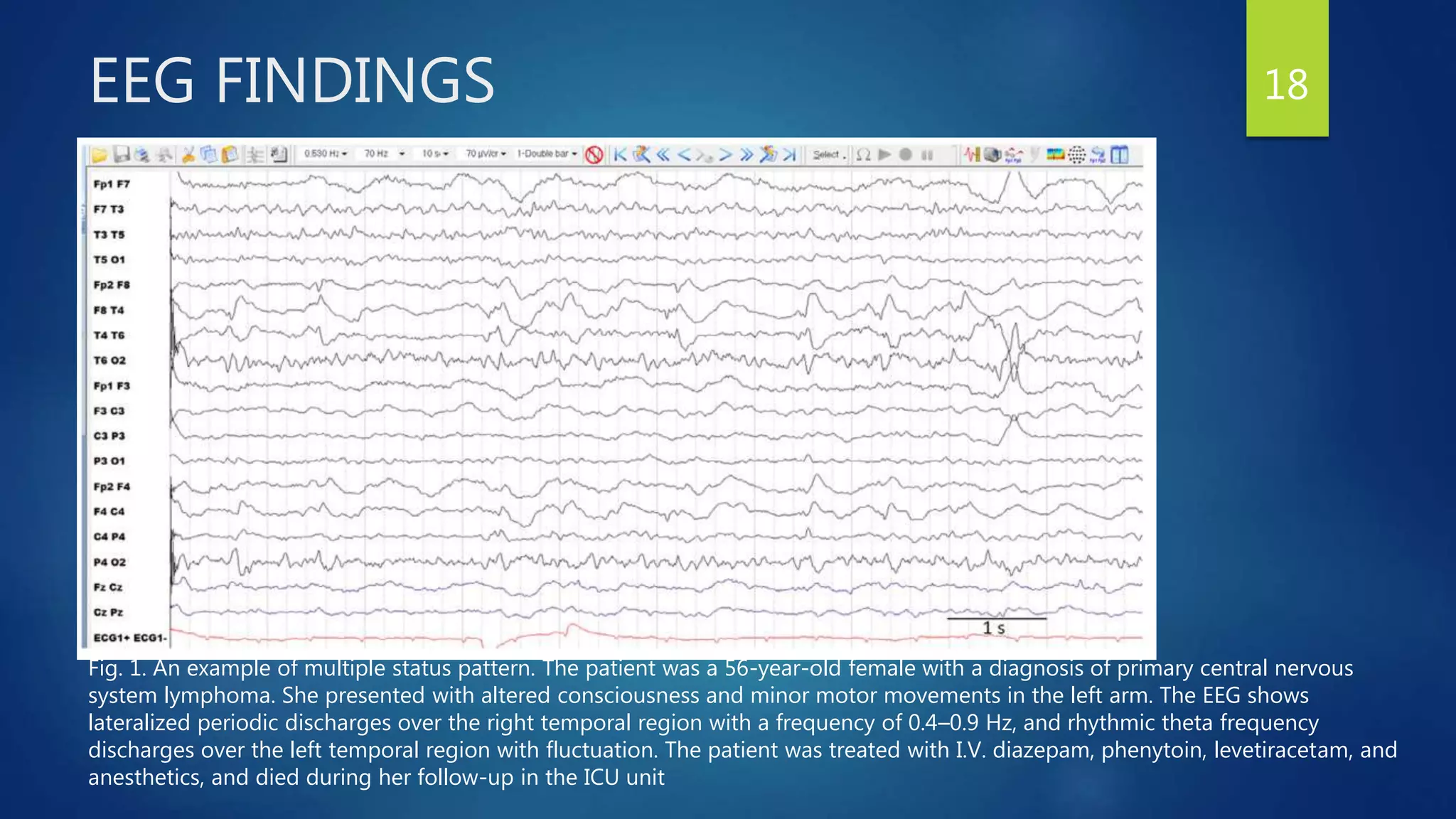 EEG - Salzburg Criteria.pptx