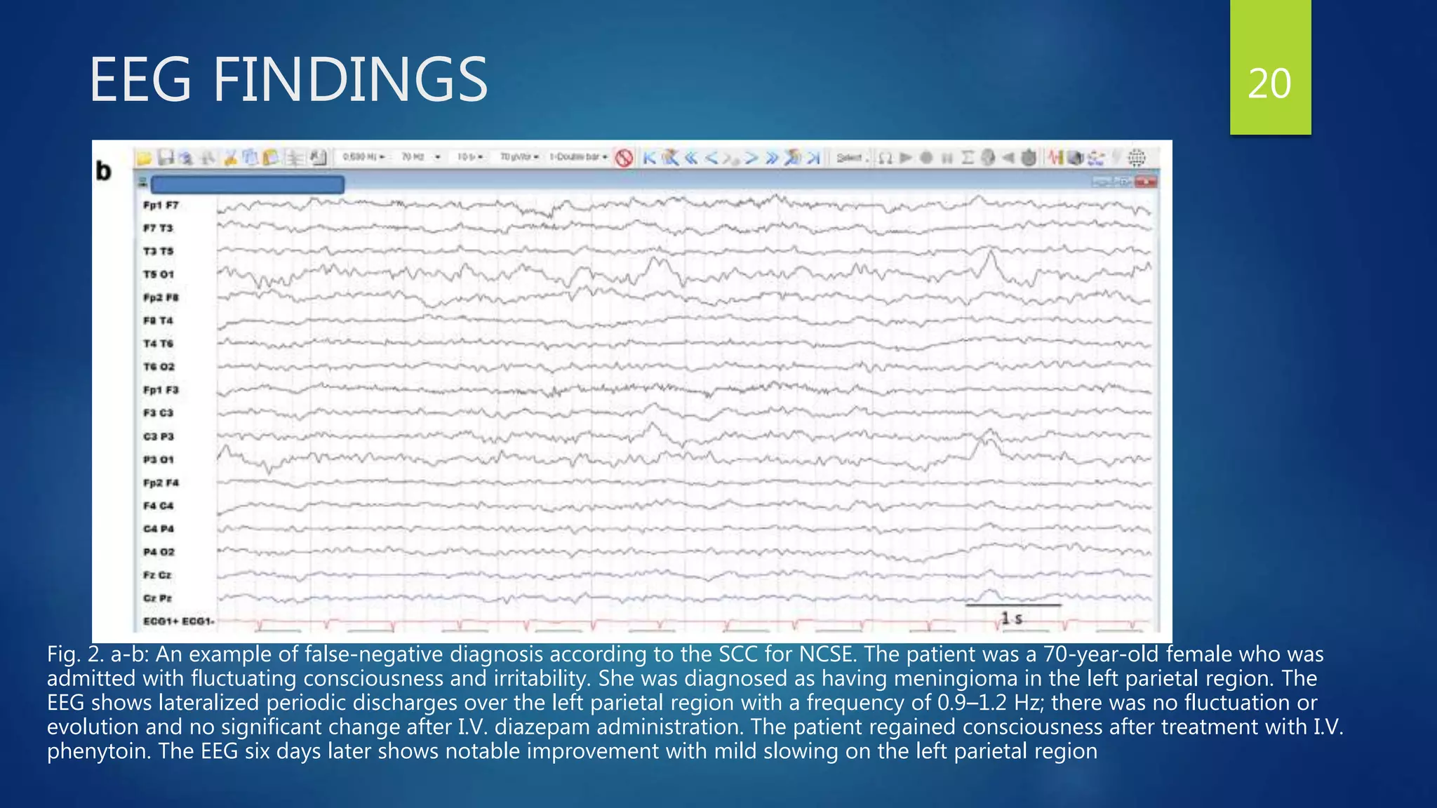 EEG - Salzburg Criteria.pptx