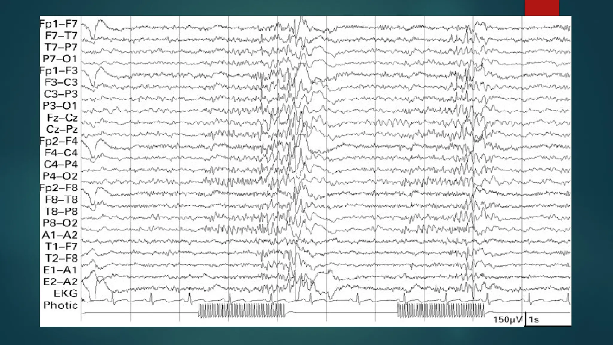 Electroencephalography neurology ppt.exe