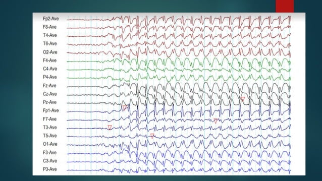 Electroencephalography neurology ppt.exe