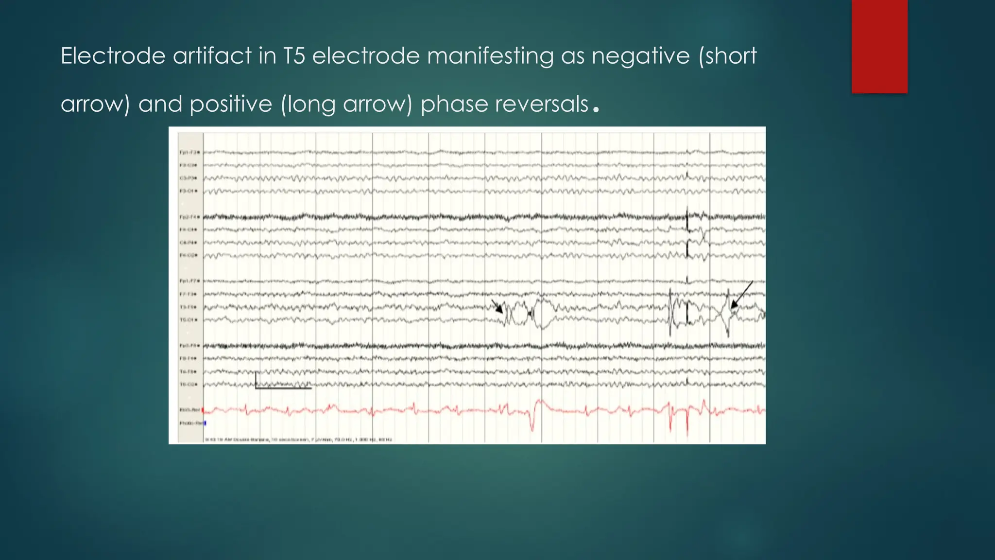 Electroenchephalography aka EEG brief ppt | PPTX