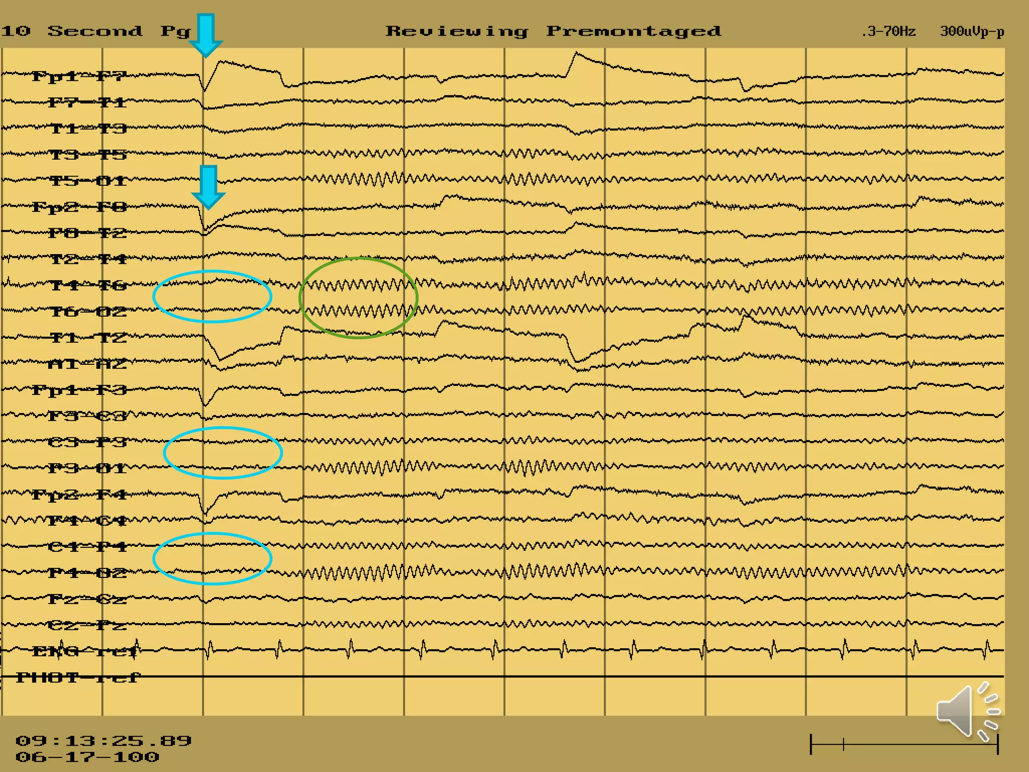 EEG basic to practice 2 | PPTX