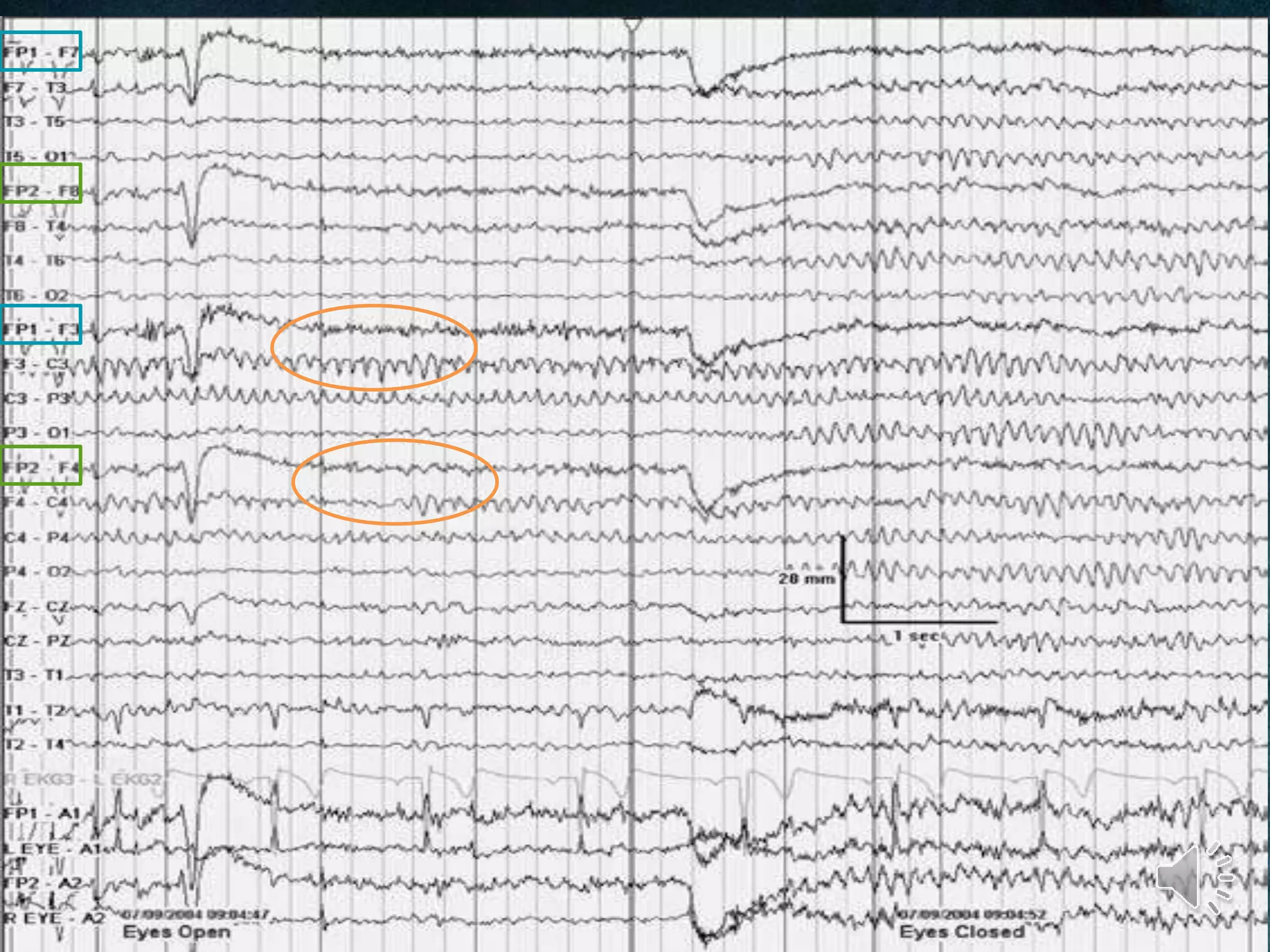 EEG basic to practice 2 | PPTX