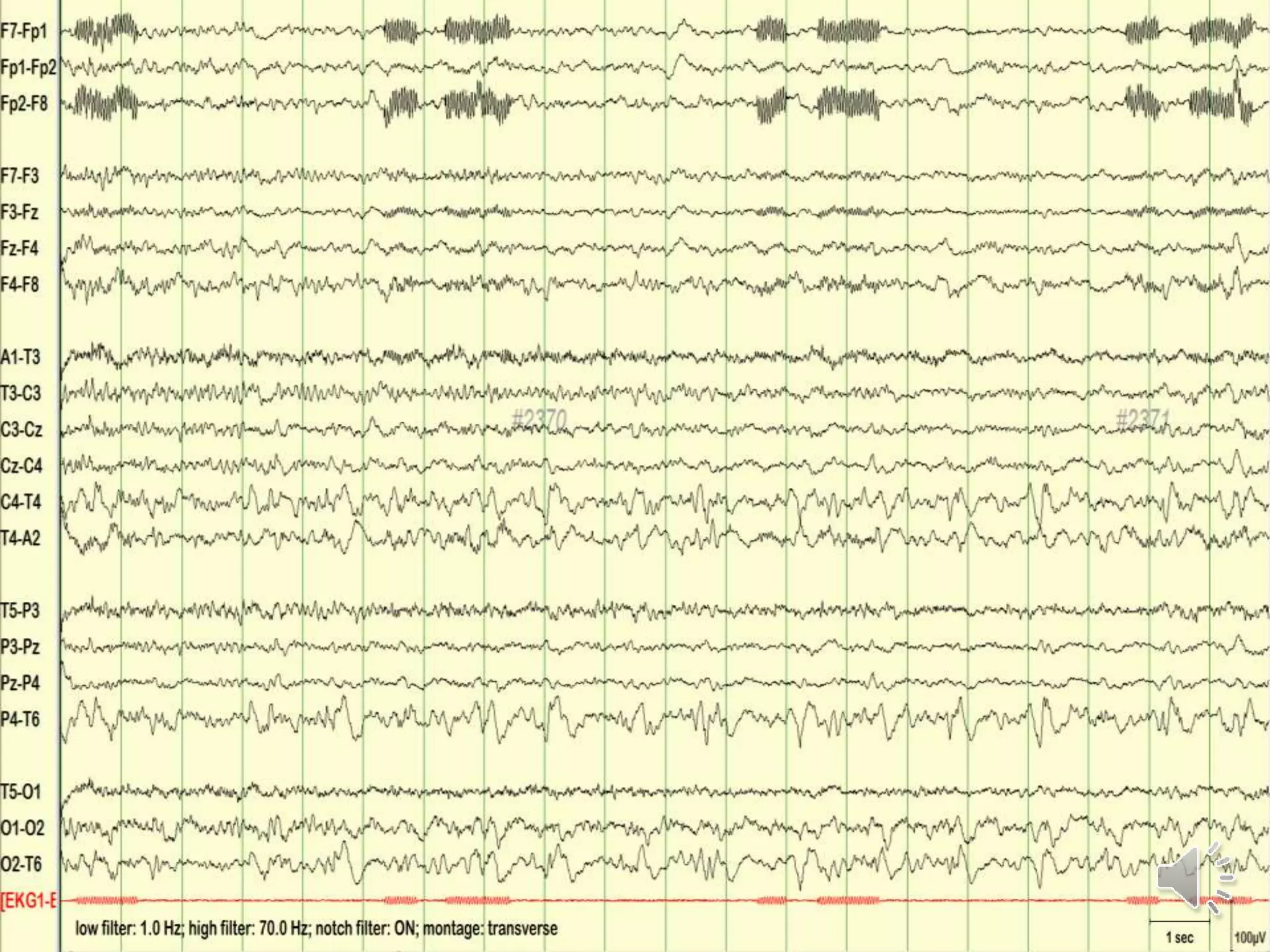 EEG basic to practice 2 | PPTX