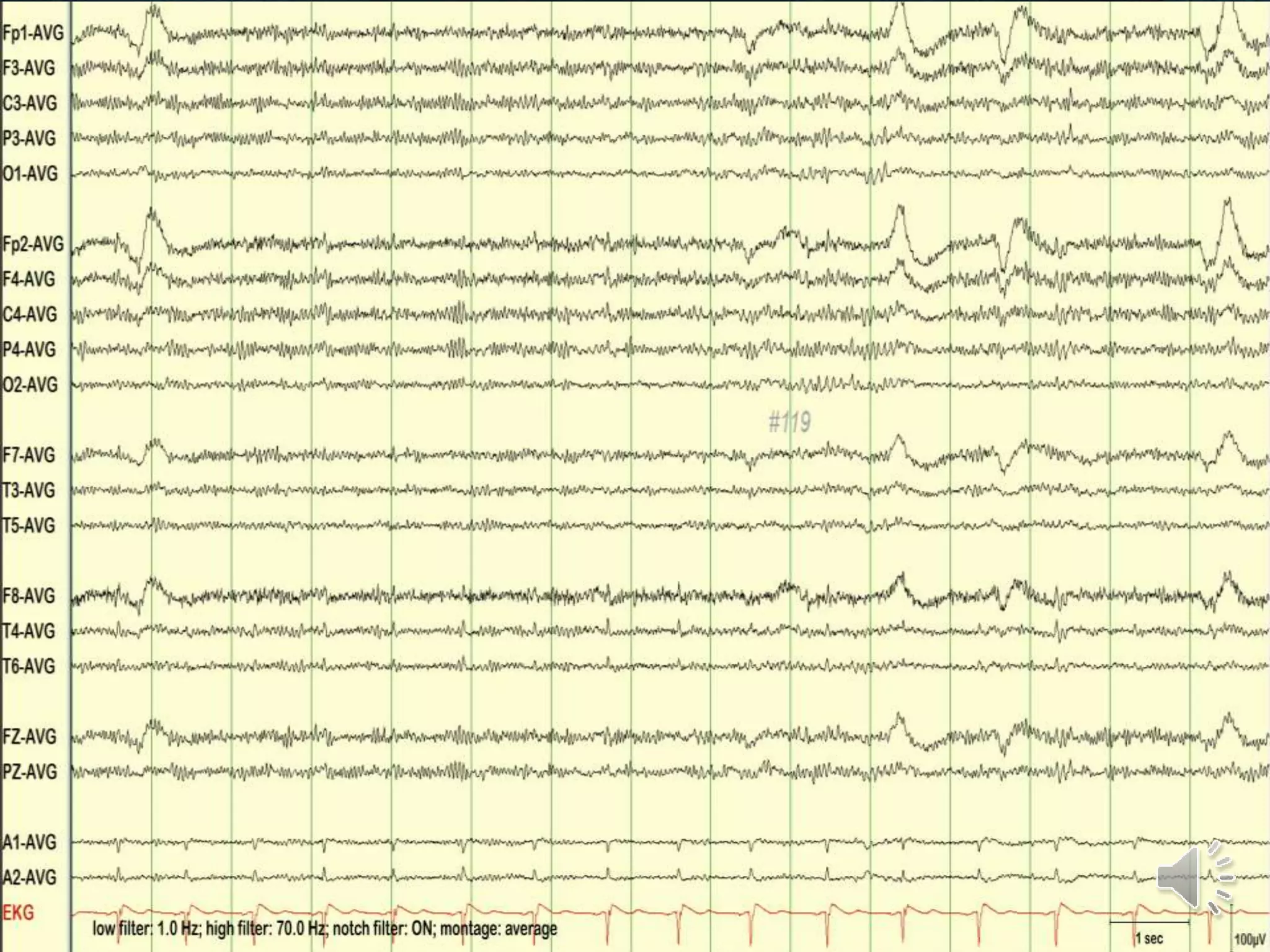 Eeg Basic To Practice 2 Ppt