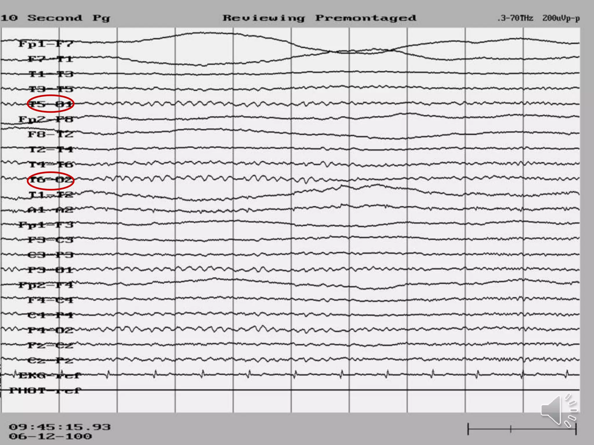 EEG basic to practice 2 | PPT