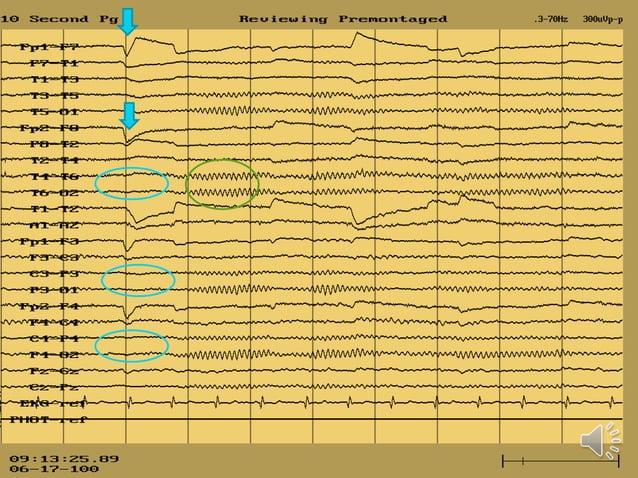EEG basic to practice 2 | PPT