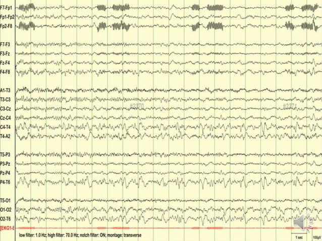 EEG basic to practice 2 | PPT