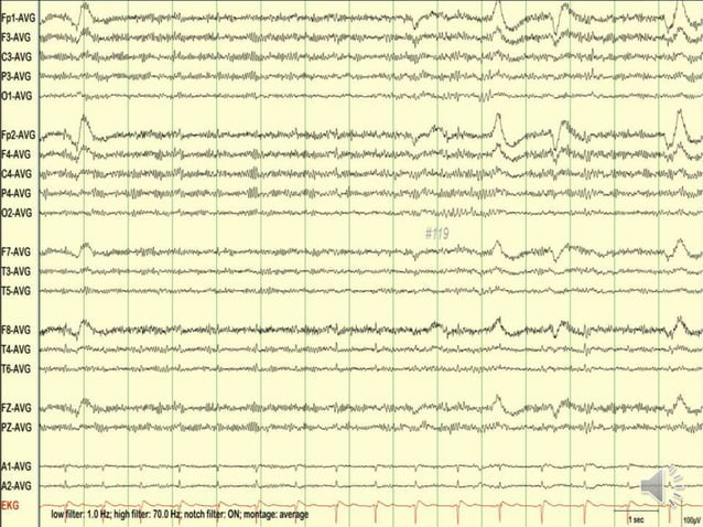 EEG basic to practice 2 | PPT