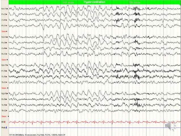 EEG basic to practice 2 | PPT