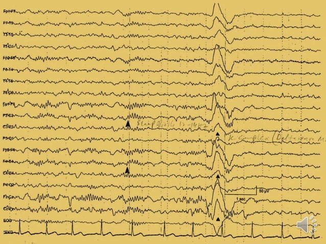 EEG basic to practice 2 | PPT