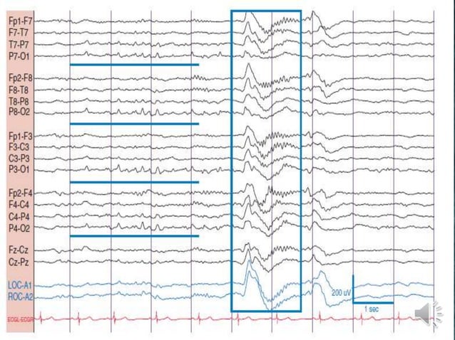 EEG basic to practice 2 | PPT