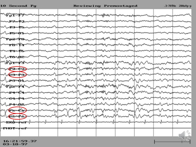 EEG basic to practice 2 | PPT