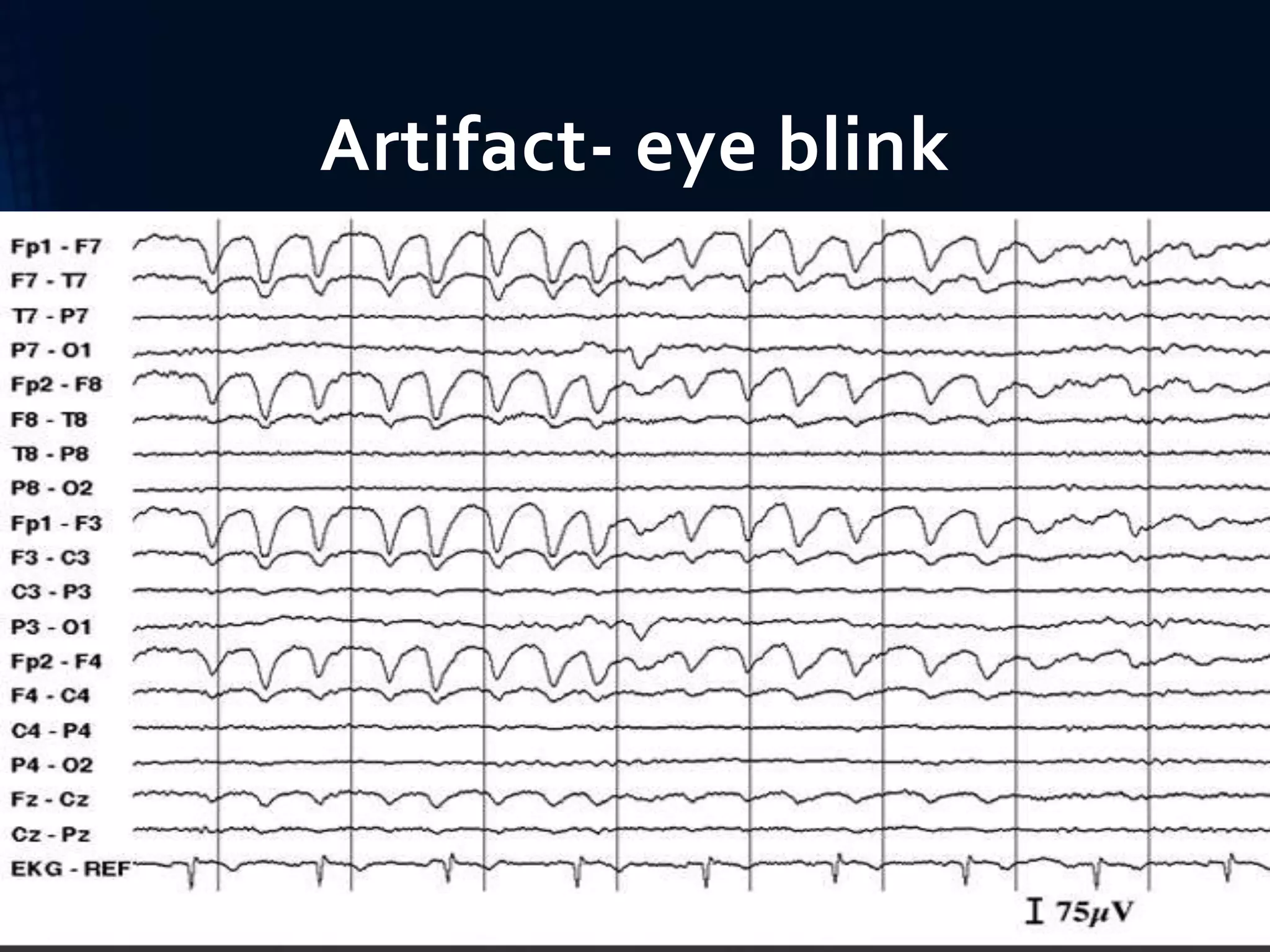 EEG of Children and Sleep | PPTX